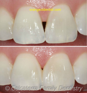 Beat the Black Triangle with Bonding | Dentist Orange, CT